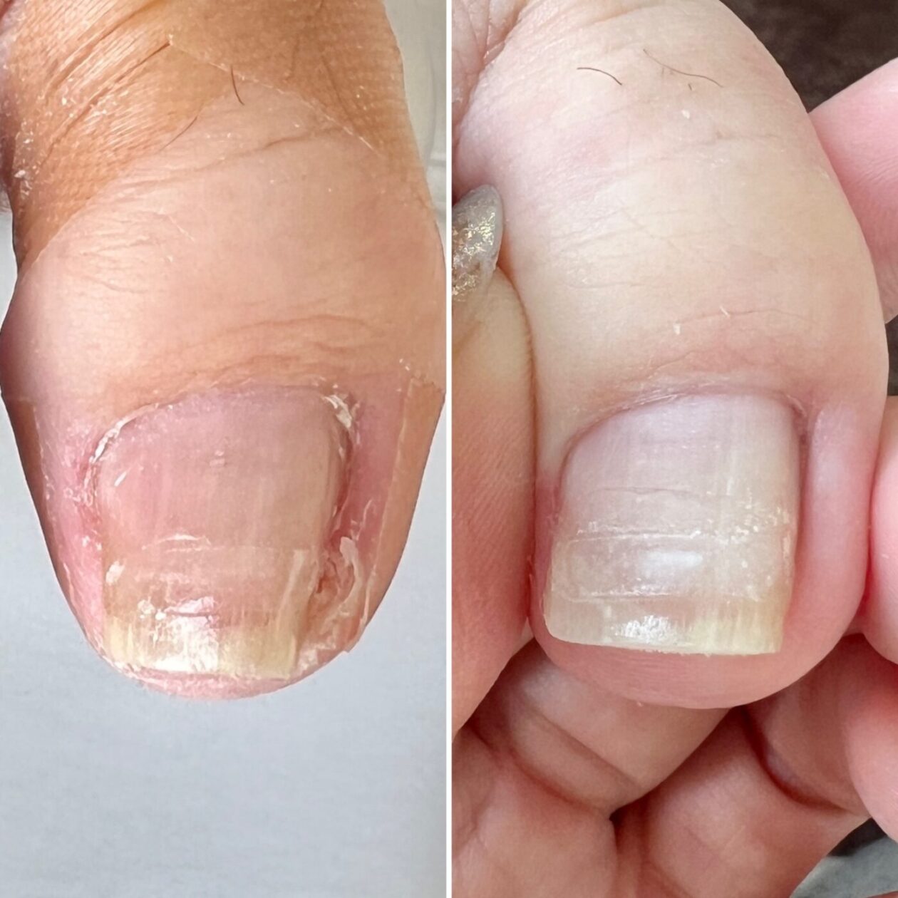 巻き爪の変化｜nail salon Adele（アデル）｜静岡市葵区にあるネイルサロン